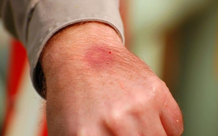 Do Paintball Scars Go Away? - PlaygroundBaron